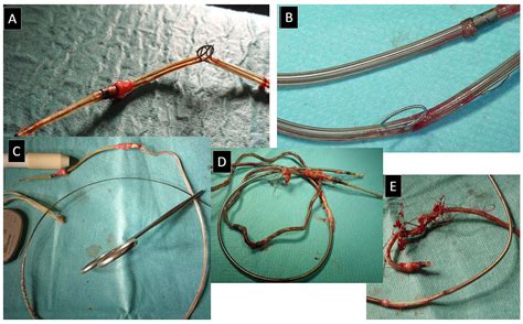 Vdd Lead Extraction—differences With Other Leads And Practical Tips In Management