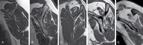 Goutallier Classification Of Rotator Cuff Muscle Fatty Degeneration Okvm