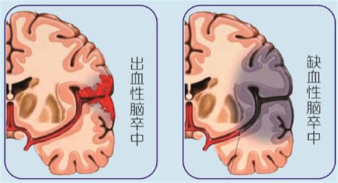 关于脑卒中