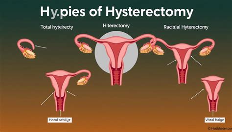 Can A Hysterectomy Cure Pcos Expert Insights