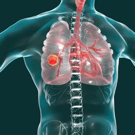 The Importance Of Needle Decompression In Tactical Medicine