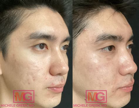 Atrophic Scarring Treatment For Atrophic Scars Dr Michele Green Md
