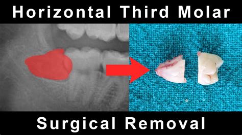 Third Molar Extraction Video Third Molar Extraction 38 Pbyb