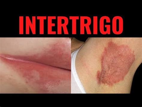 Intertrigo