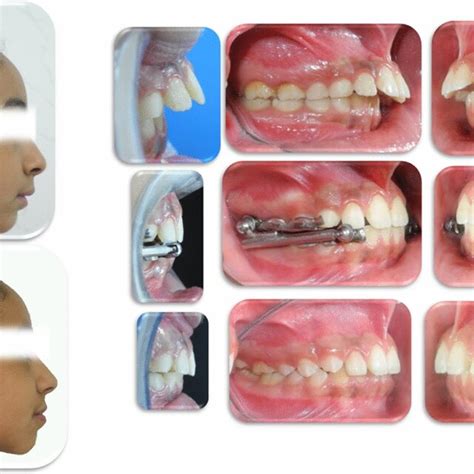 Post Pubertal Class Ii Case Before During And After Herbst Iv