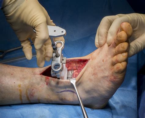 Ankle Replacement Wright Infinity Ankle Replacement Surgical Technique Orthoracle