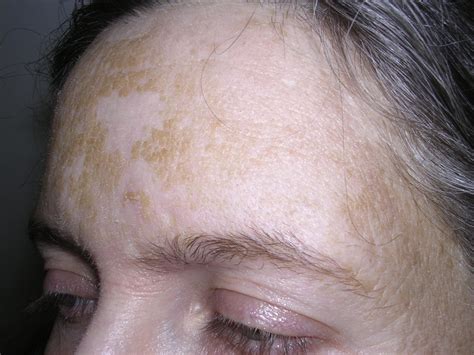 How To Get Rid Of Dermatitis Neglecta Naturally Ramutin