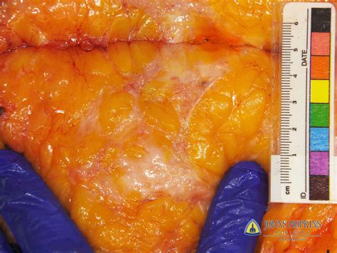 Dcis Surgical Pathology Photo Website