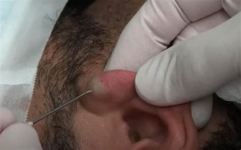 Ear Abscess Quick Pop Rpimplepopperdelight