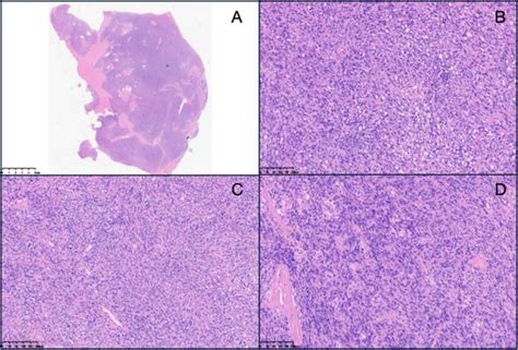Ecmo Support In Paraneoplastic Pemphigus With Respiratory Failure A