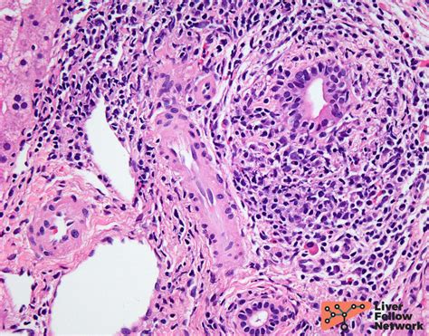 Pathology Pearls Post 7 Primary Biliary Cholangitis Aasld