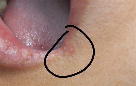 Pimple Cold Sore Angular Cheilitis R Diagnoseme