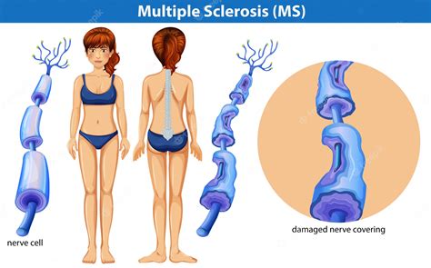 Premium Vector A Human Anatomy Of Multiple Sclerosis