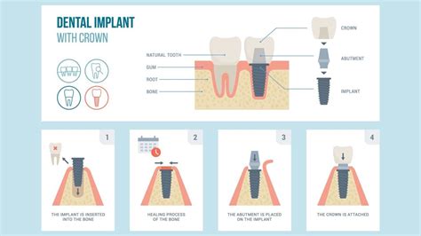 Dental Implants Process And Timeline Guide Omega Dental Houston