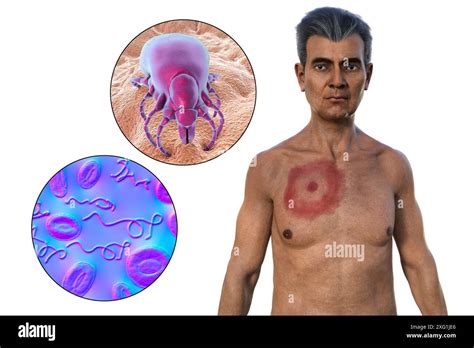 Illustration Showing Erythema Migrans A Characteristic Rash Seen In