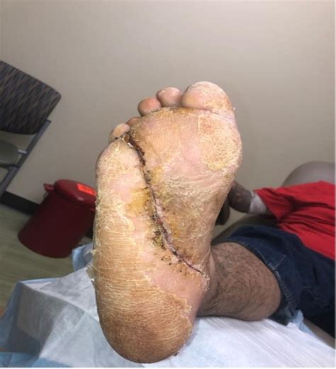 Trichophyton Species Deep Plantar Foot Abscess