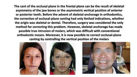 Orthodontic Correction Of Occlusal Plane Canting Part 1 Pptx Dental