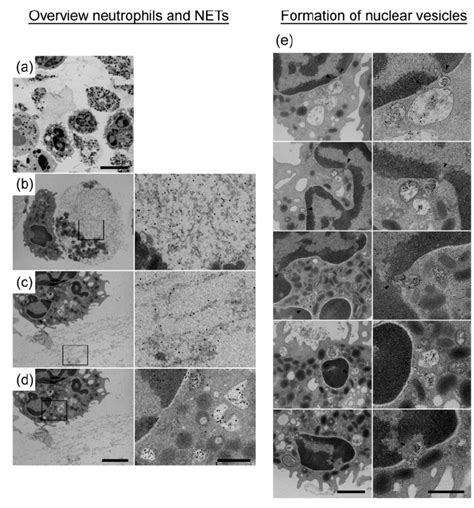 Ex Vivo Net Detection Via Transmission Electron Microscopy In Vbf Of An