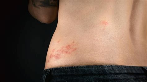 Culebrilla O Herpes Zóster Mitos Y Verdades