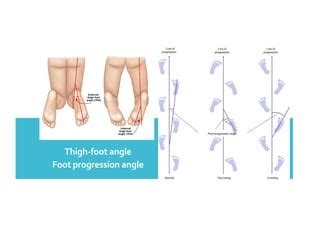 Knee And Foot Deformities In Pediatrics Pdf