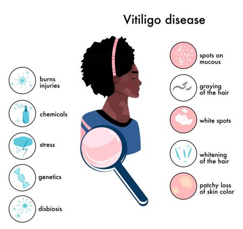340 Vitiligo Pattern Stock Illustrations Royalty Free Vector Graphics