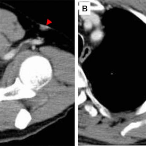 Computed Tomography Ct A Ct Shows An Irregular Mass In The Left Download Scientific Diagram