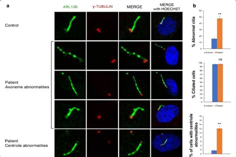 Cilia Related Phenotypes A Top Panel Control Fibroblasts Middle And Download Scientific