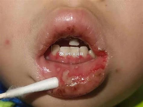 疱疹性口腔炎（龈口炎）、 疱疹性咽峡炎、唇疱疹 知乎