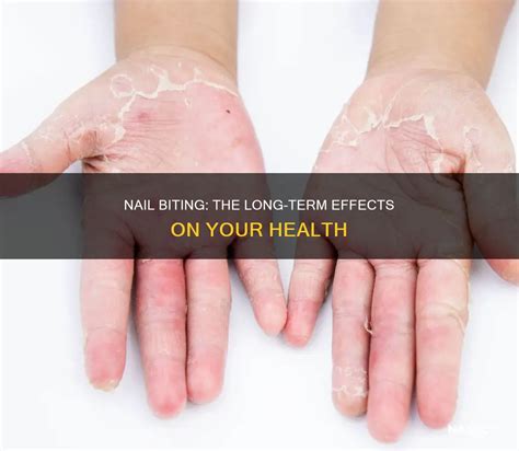 Nail Biting The Long Term Effects On Your Health Nailicy