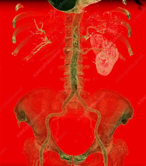 Renal Infarction Ct Scan Stock Image C0606131 Science Photo Library