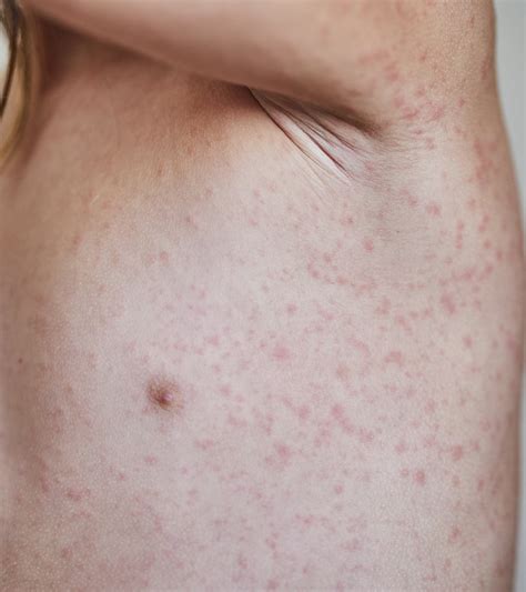 Amoxicillin Rash Is It Really An Allergy Doctors Explain