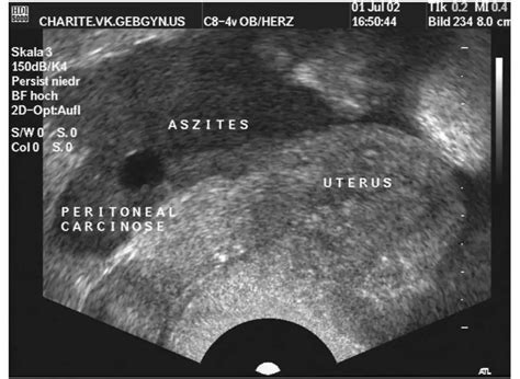 Carcinose Peritoneal Healthy Food Near Me