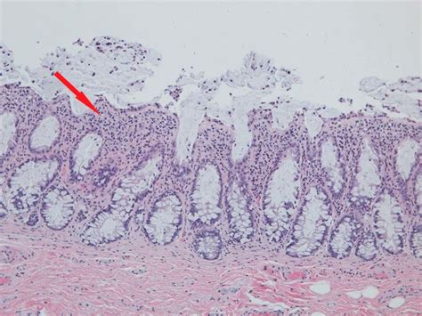 A Medium Power Photograph Of The Mucosa Of Sigmoid Colon Specimen