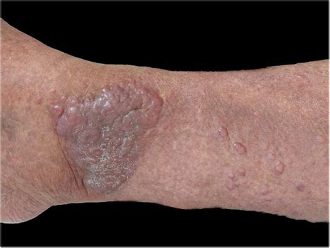 Erythematous Keloid Like Papules And Large Tumor On The Ankle