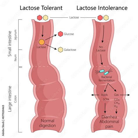 Lactose Tolerance And Intolerance Normal Digestion With Lactase And Symptoms From Bacterial