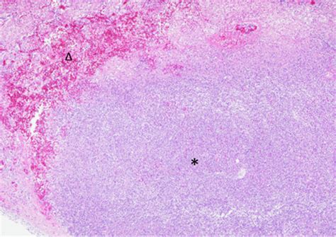 Lung Tissue With Abscess Formation And Surrounding Alveolar