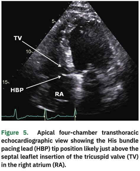 Atrioventricular Node Ablation Combined With His Bundle Pacing To