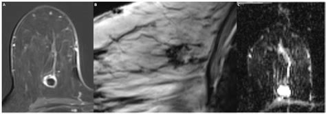 Susceptibility Weighted Breast Mri Differentiates Abscesses From