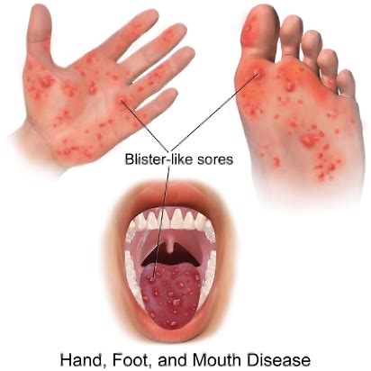 Hand Foot And Mouth Disease Notes Geeky Medics