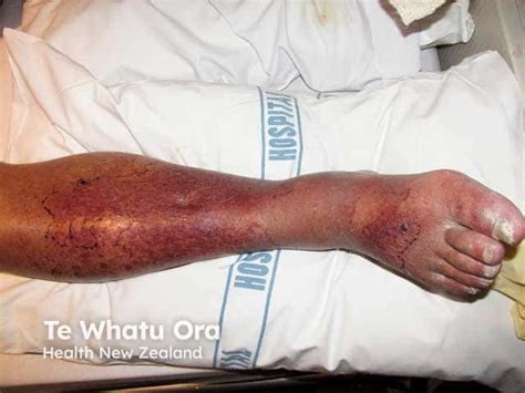 Warfarin Induced Skin Necrosis Image