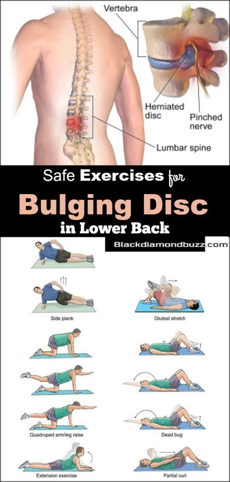 Lumbar Herniated Disc Exercises