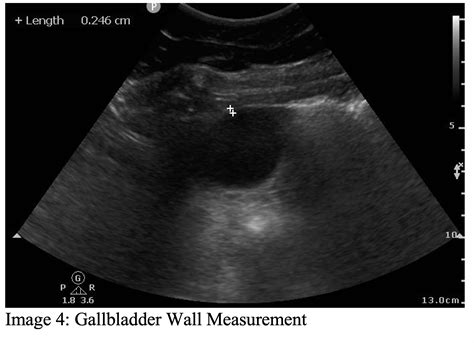 Using Point Of Care Ultrasound To Identify The Gallbladder Emdocs