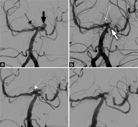 An 82 Year Old Female Presented With Rupture Aneurysm A Aneurysms Of