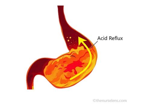 Gerd Symptoms Causes And Effective Treatment Options Thenurselens