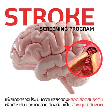 Stroke Screening ตรวจคัดกรองโรคหลอดเลือดสมอง By Bnh Hospital