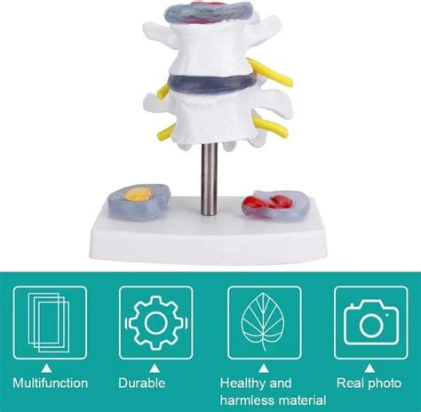 Intervertebral Disc Herniation Bone Pathology Model Lumbar Spine Bone