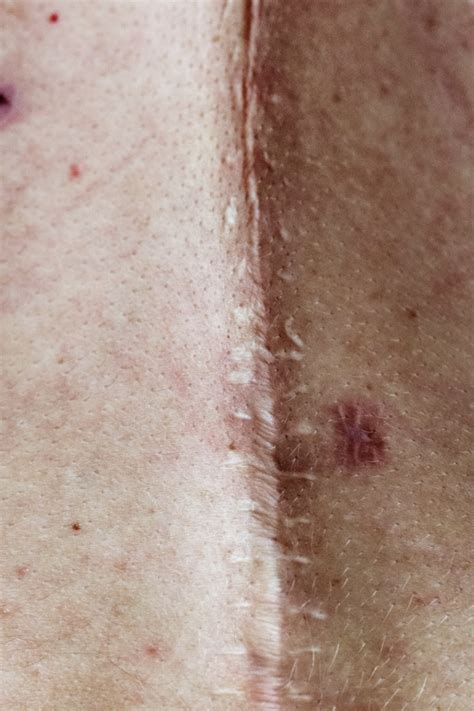 Scar Related Conditions