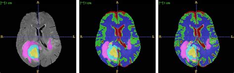I Manual Segmentation Using Svm Ii Hierarchical Svm With