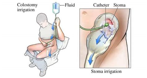 Colostomy Irrigation How It Can Help Ostomate On Board