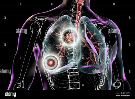 Illustration Of Primary Lung Tuberculosis With The Ranke Complex Highlighting Pulmonary Lesions